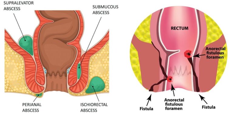 Anal Fistula vs. Anal Abscess: How to Tell the Difference?