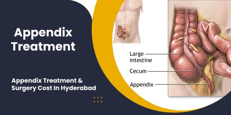 Appendix Treatment Surgery Cost in Hyderabad | Affordable Appendix Operation by Dr. N. S. Babu